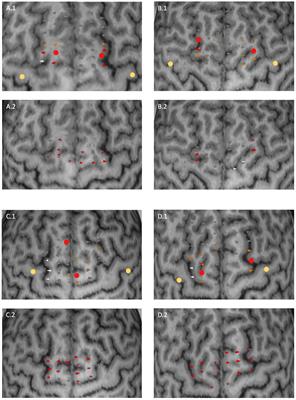 Frontiers | Mapping of the supplementary motor area using repetitive navigated transcranial ...